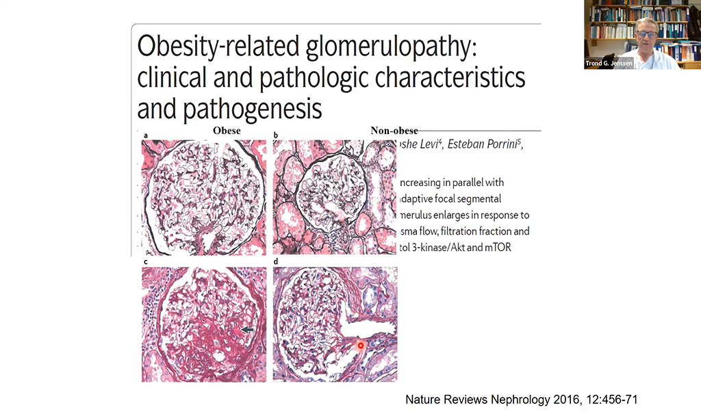 Fatty Kidney and Obesity - EASO
