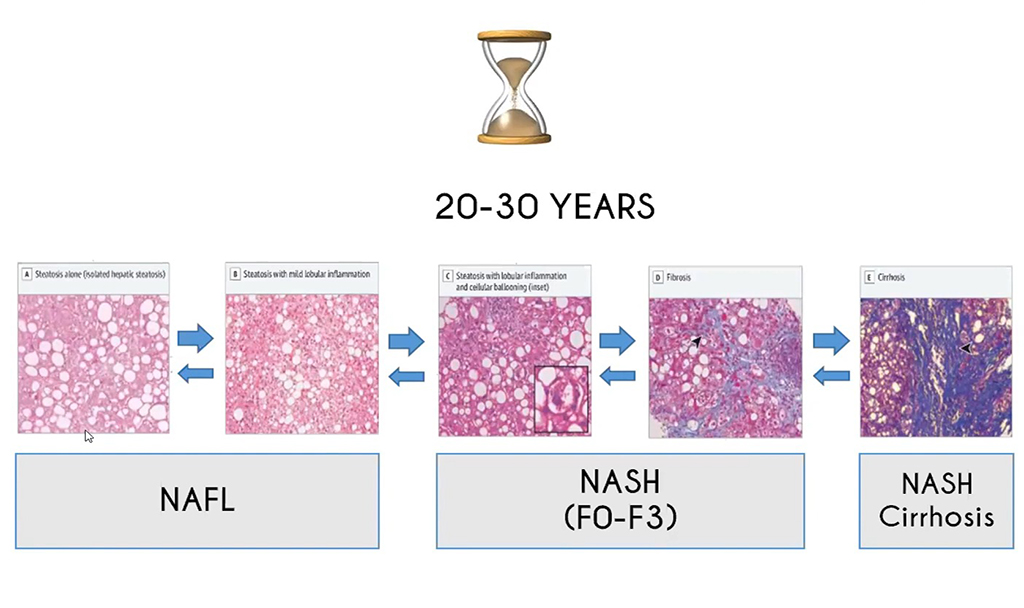 Diagnosis and Management of MAFLD - EASO